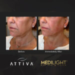 What to Expect During and After ATTIVA Treatment - Medilight