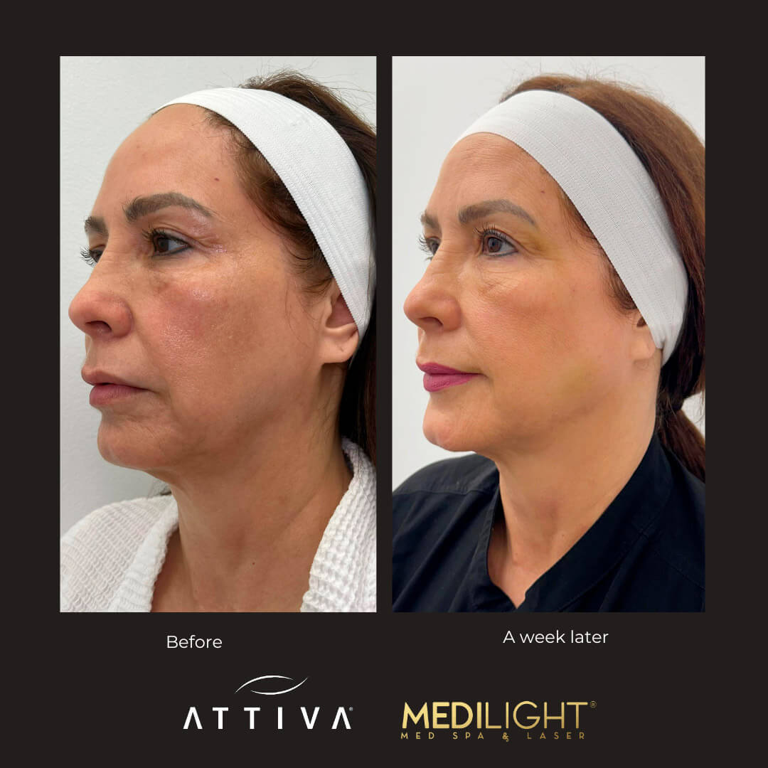 What to Expect During and After ATTIVA Treatment - Medilight